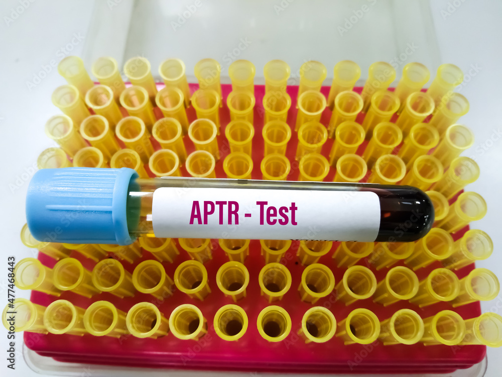 Blood sample tube for Activated Partial Thromboplastin Ratio (APTR ...