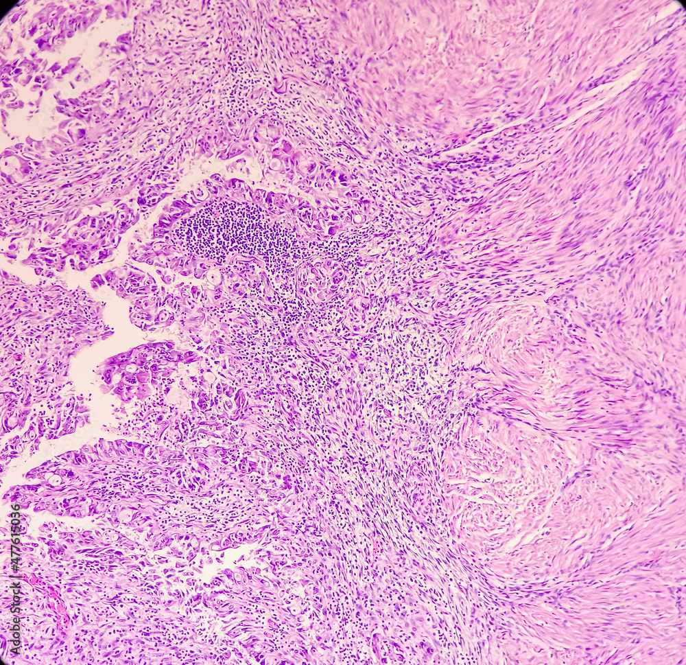 Fotografia do Stock: Uterus wall: Simple endometrial hyperplasia, show ...