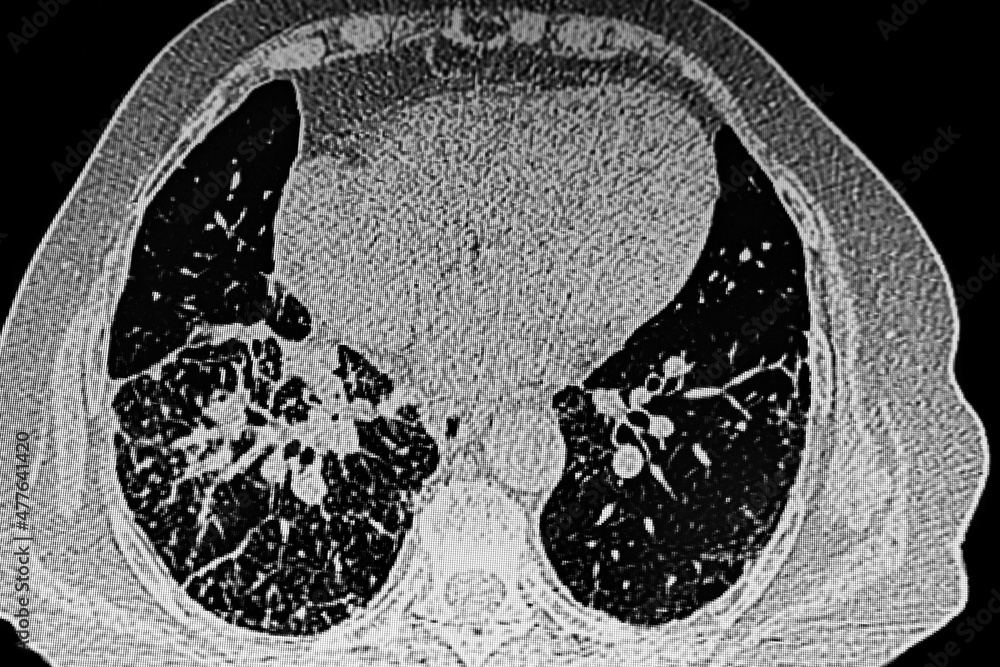 Pneumonia lung infection X- Ray Stock Photo | Adobe Stock