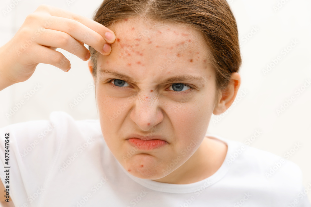 Foto Stock face of a teenage girl with pimples, she looks at herself in ...