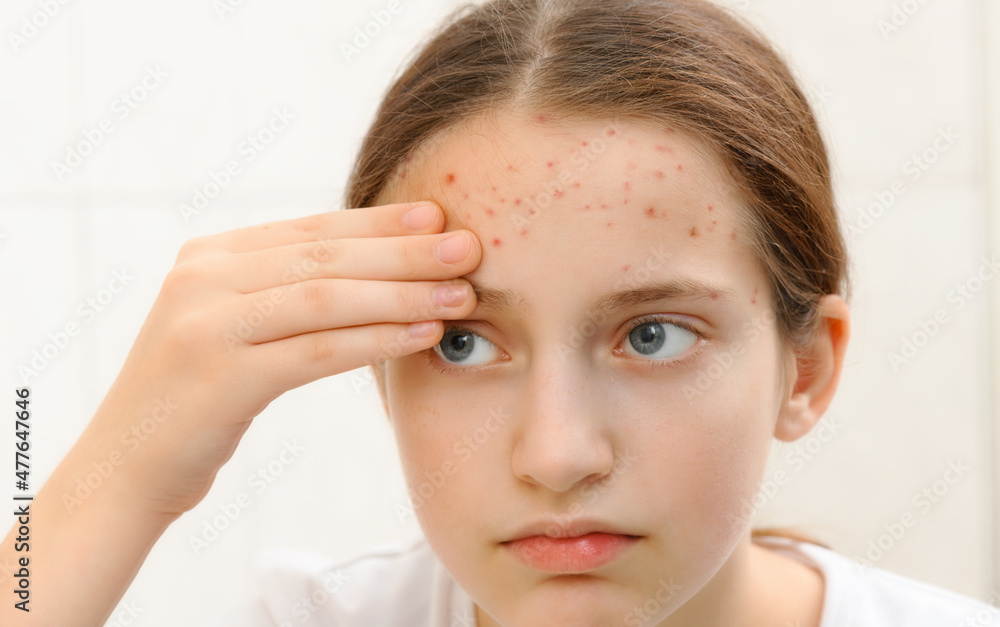 portrait of a teenage girl touches her face with pimples, acne on the ...