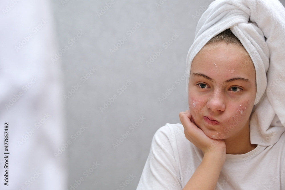 Acne treatment. A teenage girl twisted her face, which she does not ...
