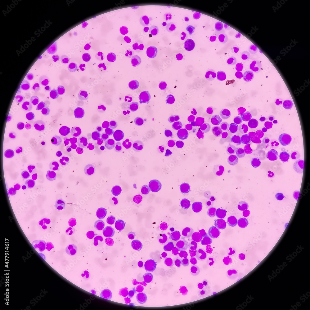Foto de Microscopic view of bone marrow slide, megaloblastic anemia ...