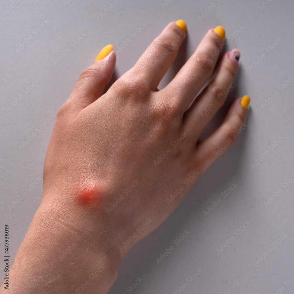Ganglion cyst on woman hand on white background Stock Photo | Adobe Stock