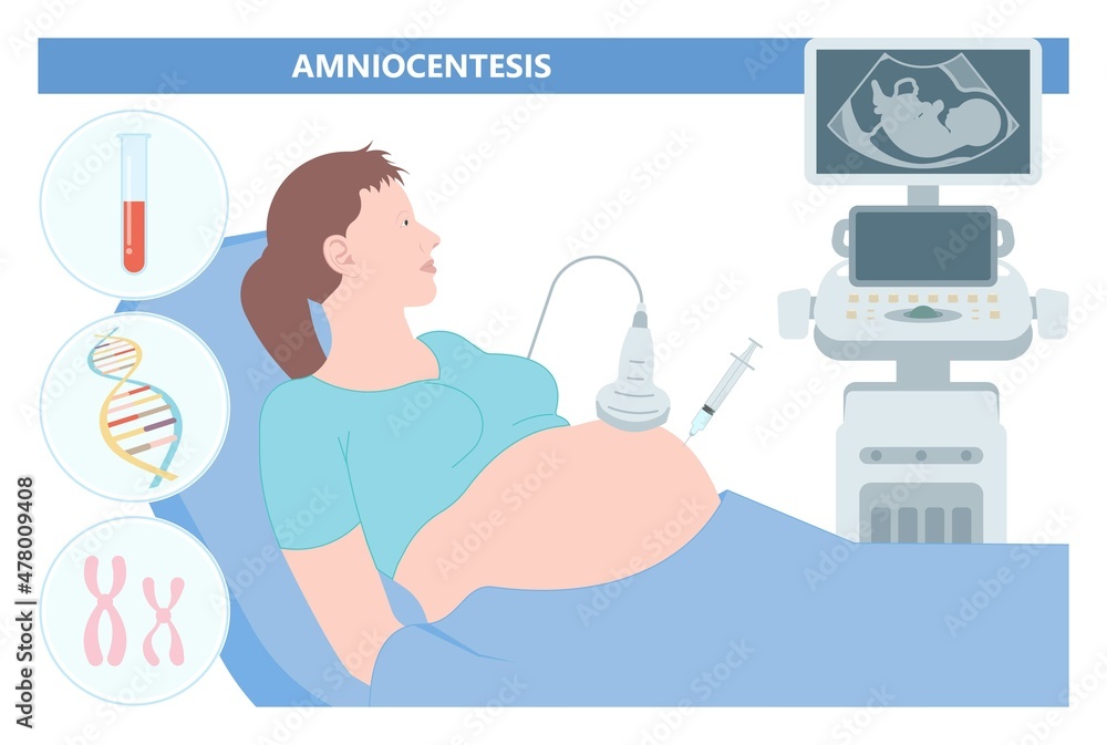 Amniocentesis diagnostic test treat LAB analysis DNA gene screen risk ...