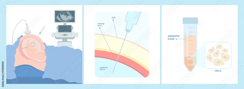 Amniocentesis diagnostic test treat LAB analysis DNA gene screen risk ...