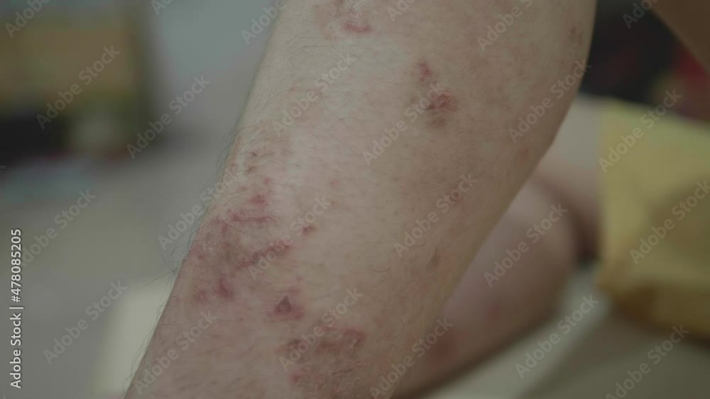 Young boy has Chronic rash on the skin. Grass allergic skin disease ...