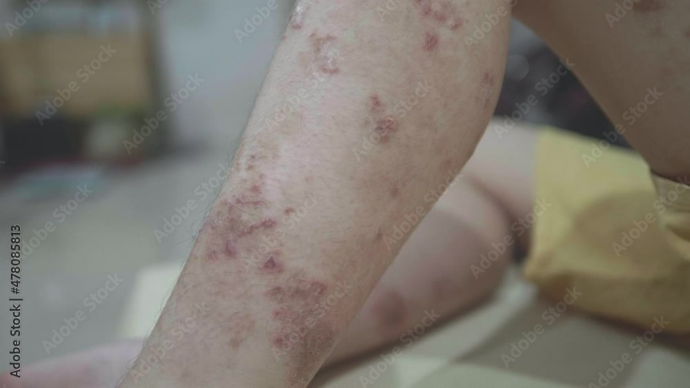 Video Stock Young boy has Chronic rash on the skin. Grass allergic skin ...