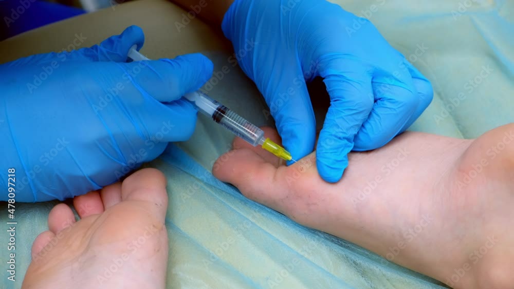 Surgeon in gloves is making injection of local anesthesia on boy's foot ...