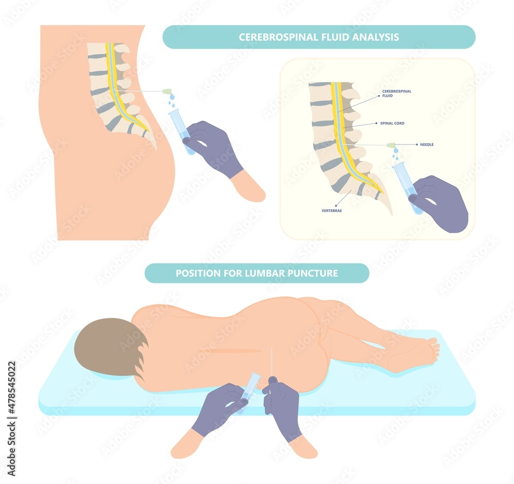 Lumbar puncture for infalmmation Bleeding cancer brain inject ...
