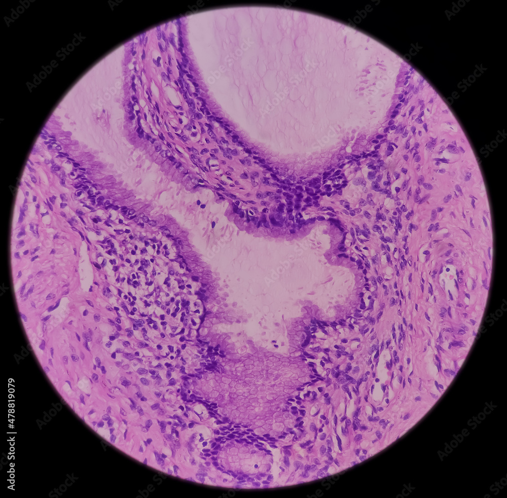 Fotografia do Stock: Ectopic pregnancy, fallopian tube show degenerated ...