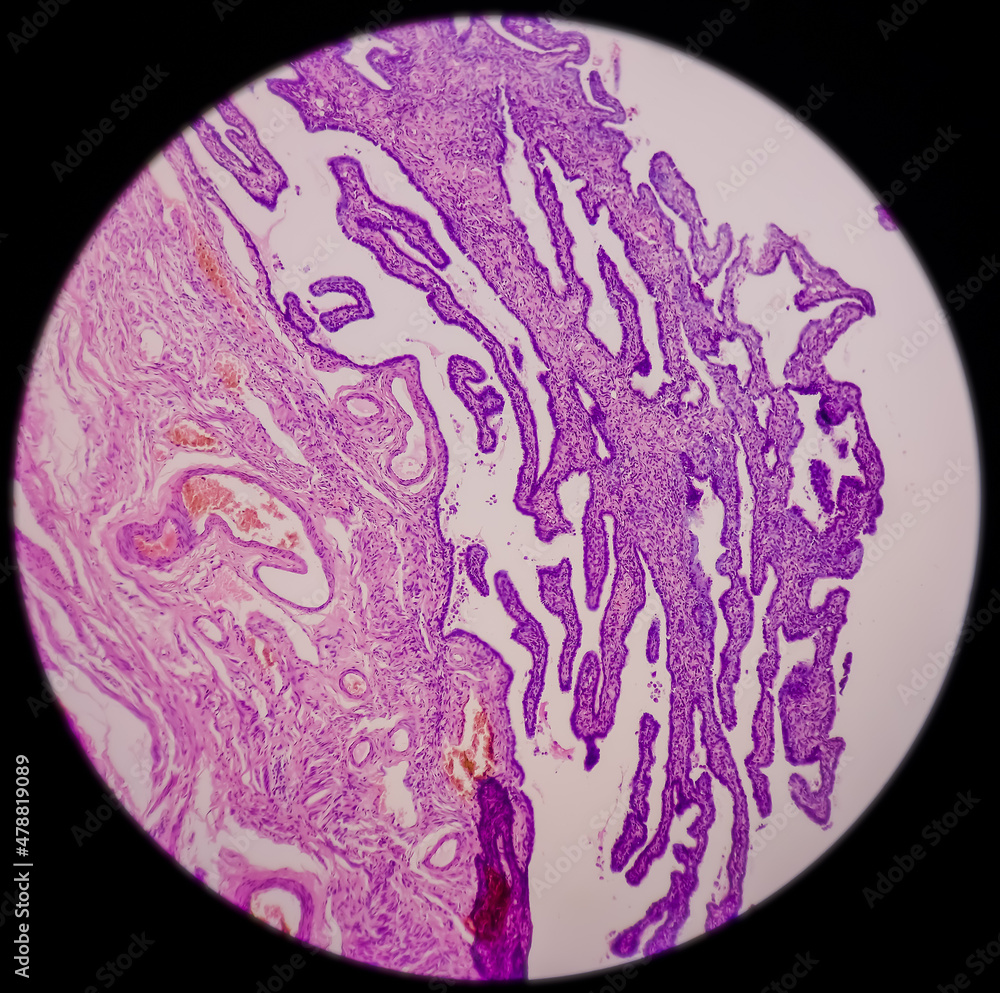 Ectopic pregnancy, fallopian tube show degenerated chorionic villi with ...