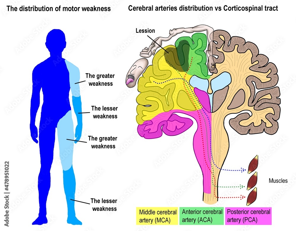 The different pattern of motor weakness according to the different ...