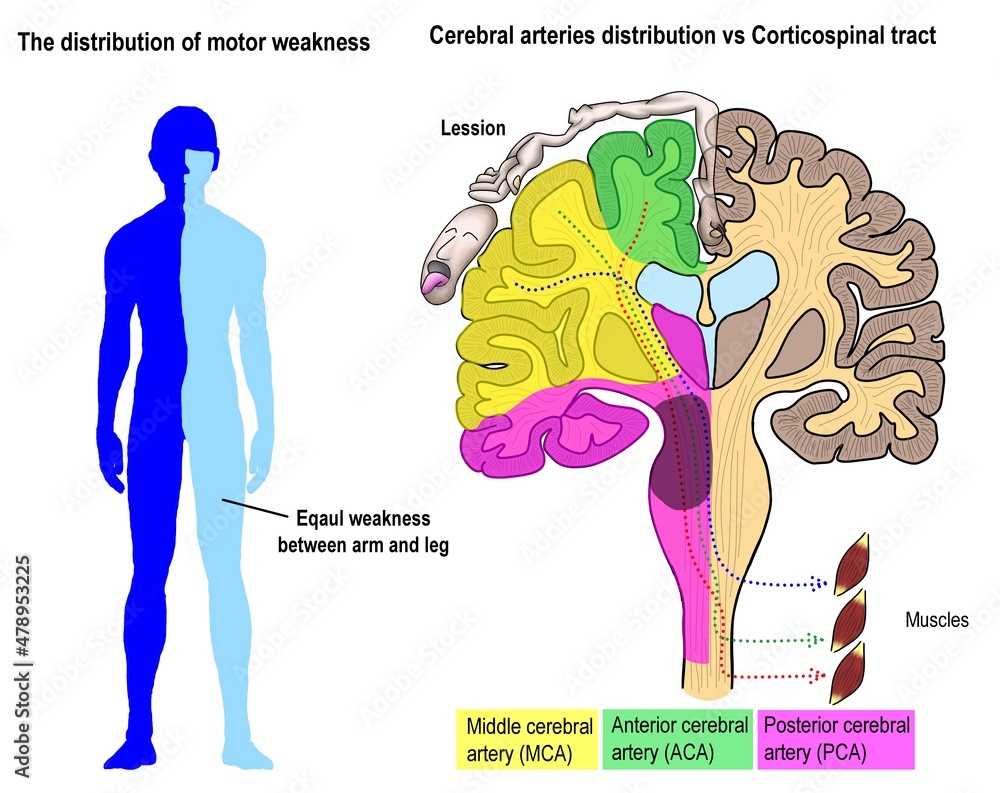 The pattern of hemiparesis in brainstem infarction lesion. Stock ...