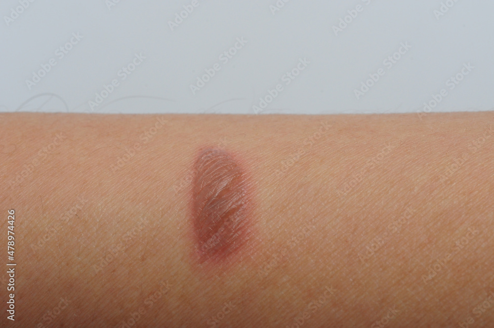 Blister was caused by a burn or scald, sunburn, or an allergic reaction ...