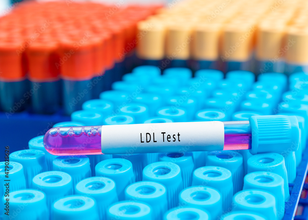 Biochemistry Blood sample for LDL low-density lipoprotein test Stock ...
