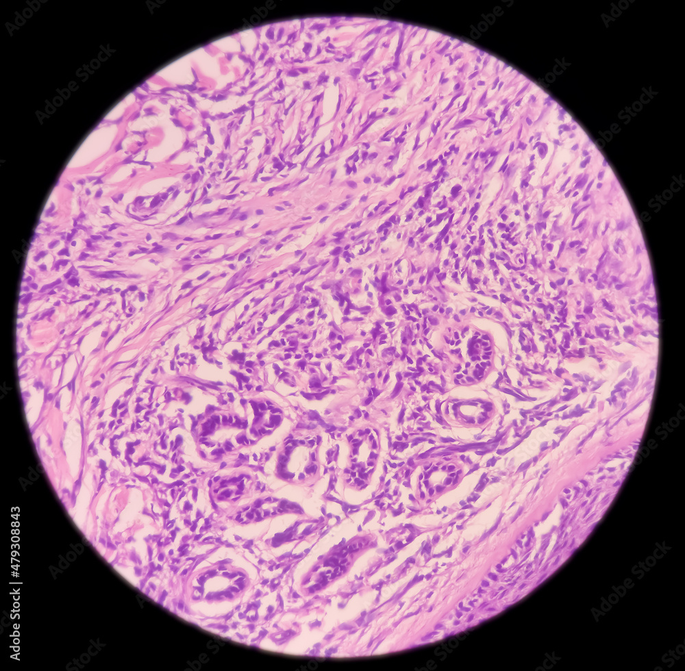 Tissue from scalp: tumors of Skin, microscopic image of a ...