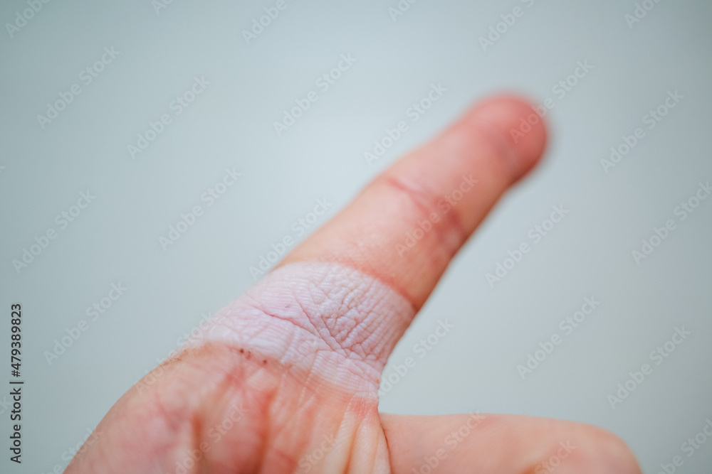 Wound on the index finger. Flabby skin on his arm. The site of skin ...