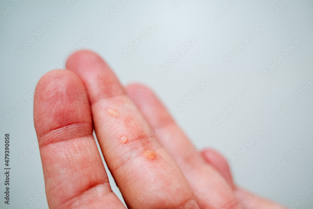 Wart on the finger of the hand. Papilloma on the arm. Skin disease ...