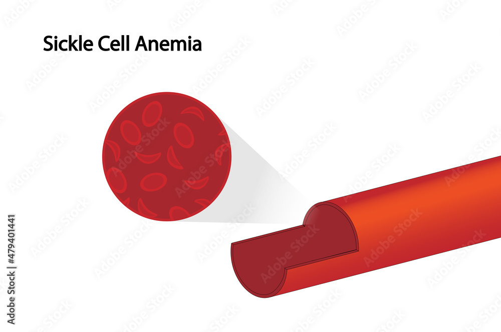 Sickle Cell anemia illustration. Hemoglobin sickle cell in blood vessel ...