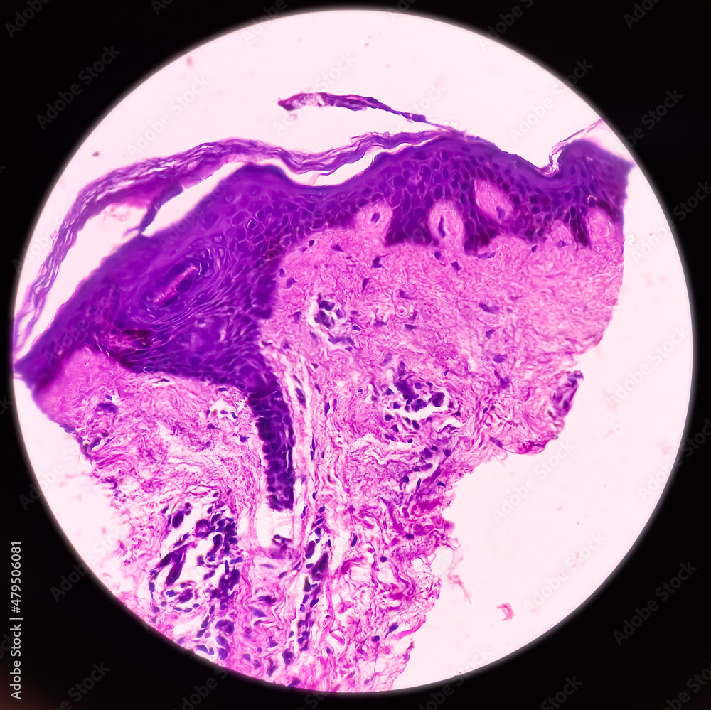 Chest Wall Cystbiopsy Epidermal Inclusion Cyst Commonly Called Sebaceous Cyst Showing