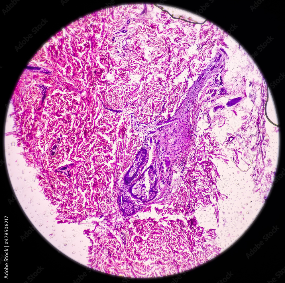 Chest Wall Cystbiopsy Epidermal Inclusion Cyst Commonly Called Sebaceous Cyst Showing