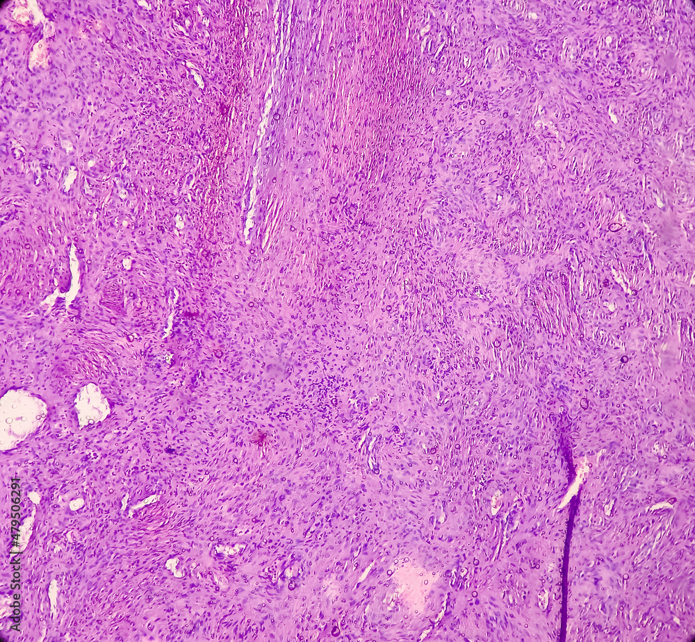 Tissue From Ring Finger Neurofibroma A Type Of Benign Tumor Of Neuroectodermal Origin Benign