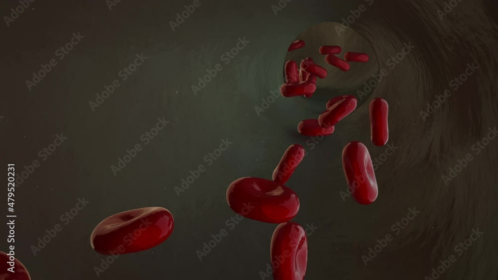Vidéo Stock Narrowing of the arteries due to the formation of plaques ...