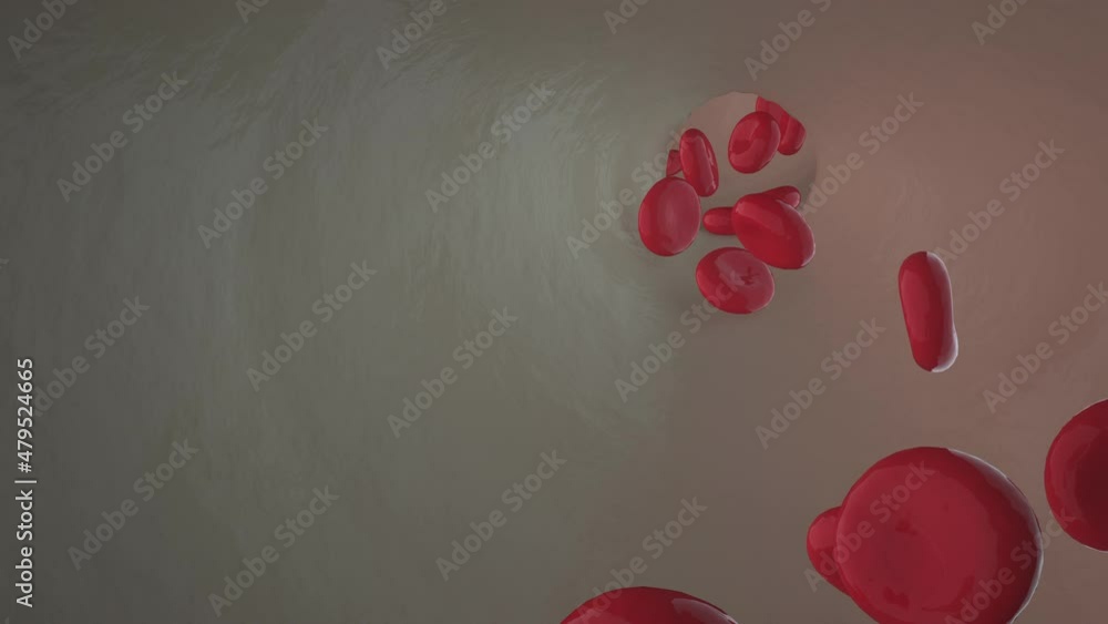 Narrowing of the arteries due to the formation of plaques on their ...