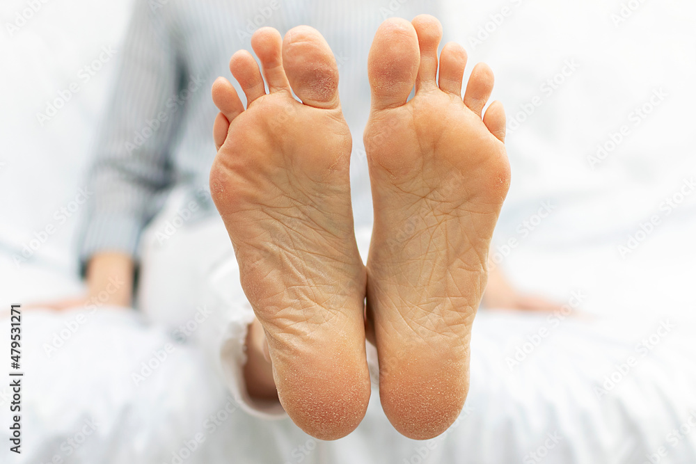 Close-up of dry skin of feet, damaged cracked sole with scales and ...