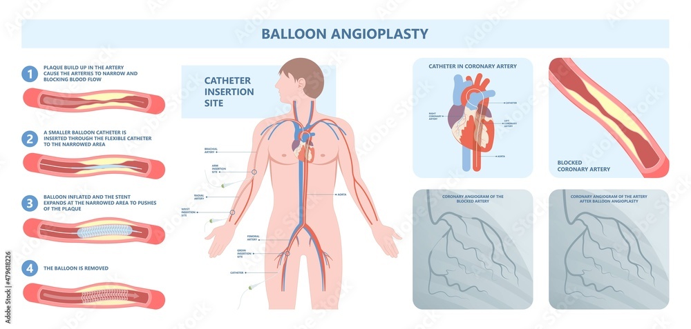Angiography medical operation Angiogram Biopsy Angioplasty Stent ...