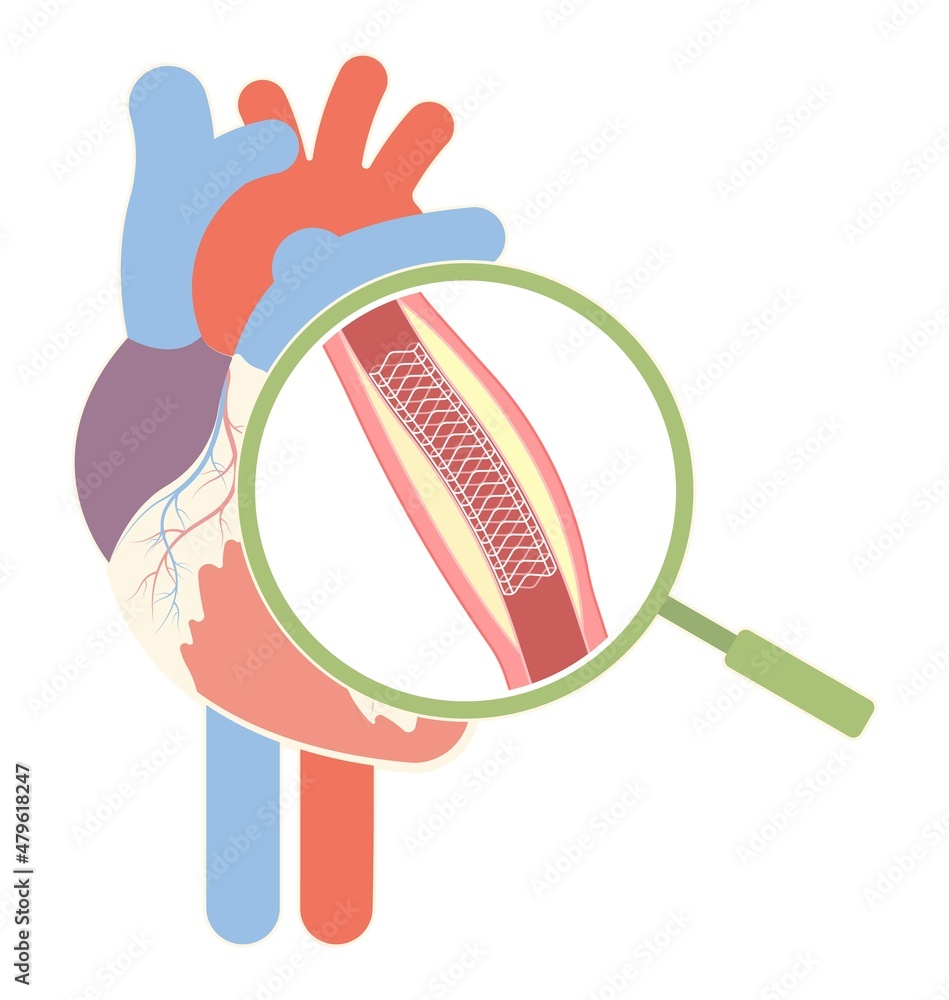 Angiography medical operation Angiogram Biopsy Angioplasty Stent ...