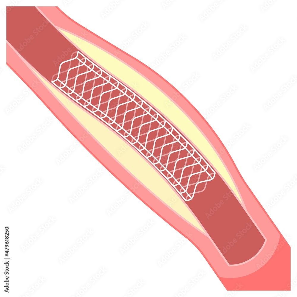 Angiography medical operation Angiogram Biopsy Angioplasty Stent ...