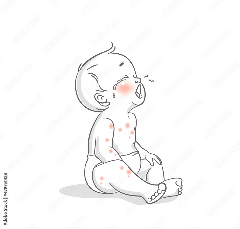 Cute little baby with skin problem sitting on floor and crying. Vector ...