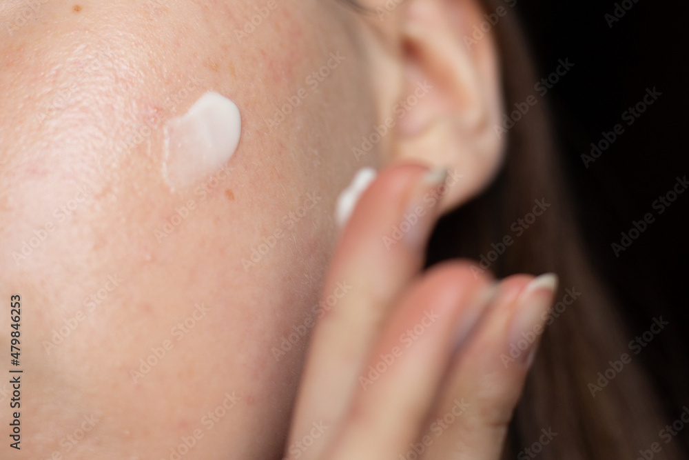 Closeup of a young woman applying prescription azelaic acid to her acne ...