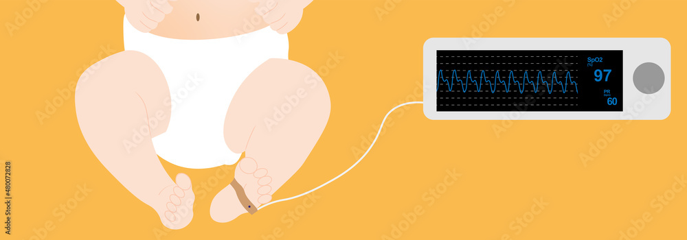 Newborn pulse oximetry monitoring. Sensor placed in the foot of a ...