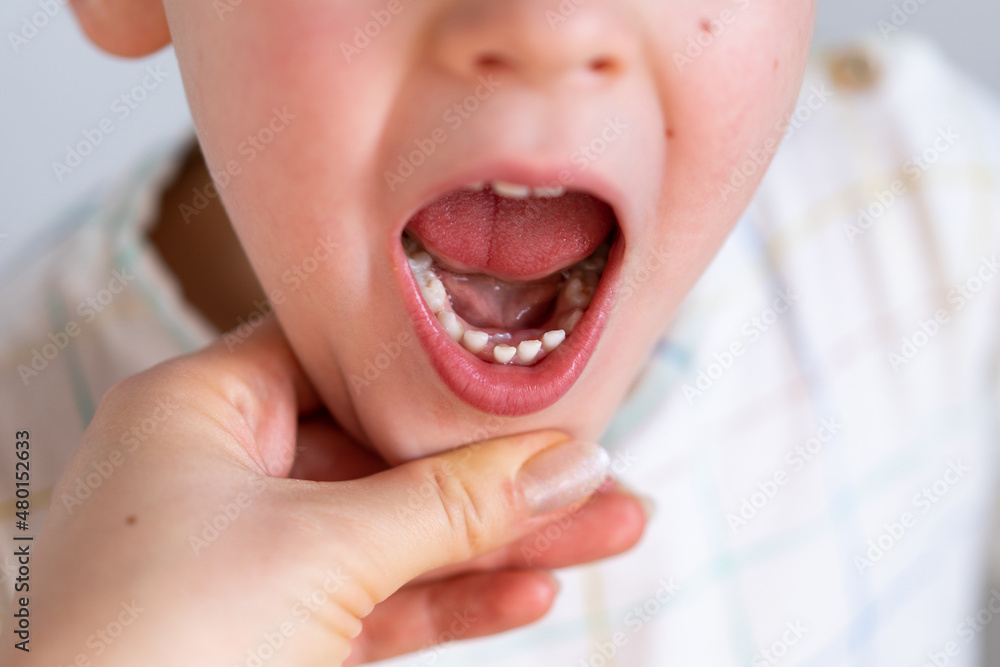 Children shark teeth, first tooth that appears in childhood behind baby ...