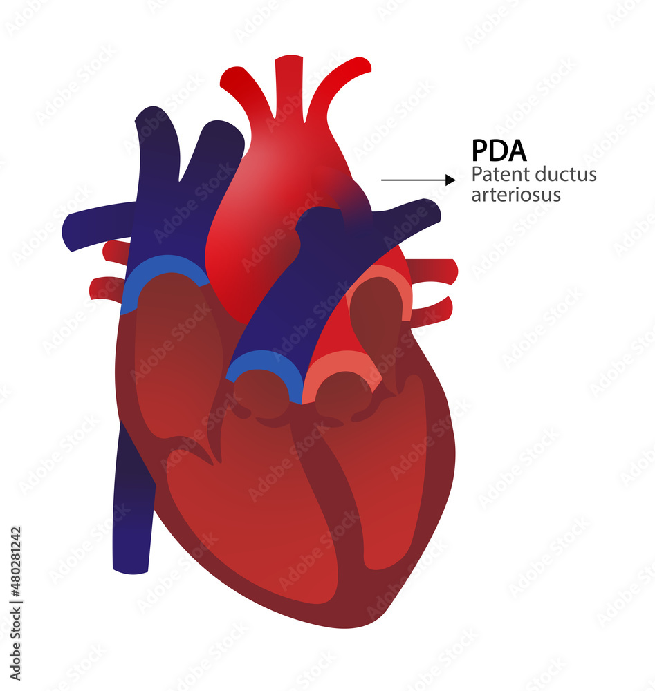 Patent ductus arteriosus. PDA in a anatomy heart illustration Stock ...