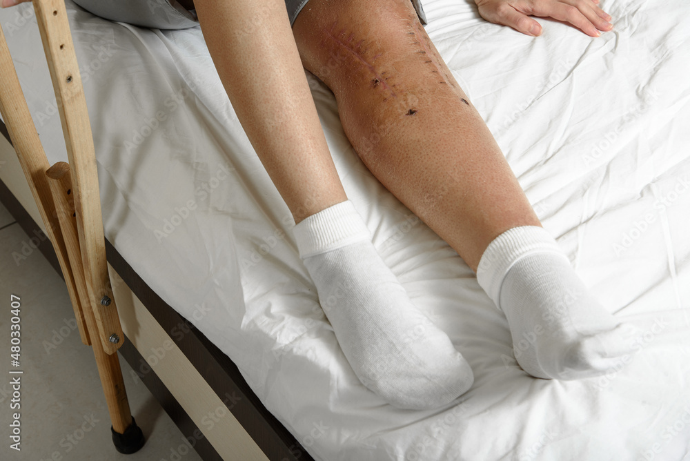 Female patient with postoperative suture after surgery on broken leg ...