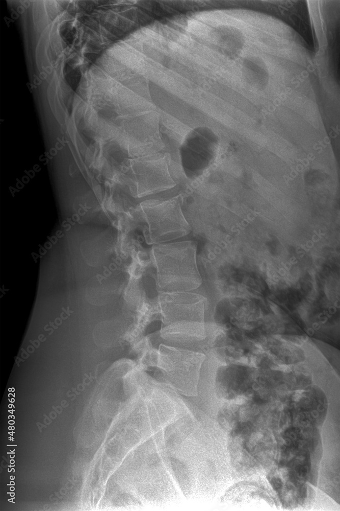 Lumbar Spine Radiography, in lateral-lateral projection Stock Photo ...