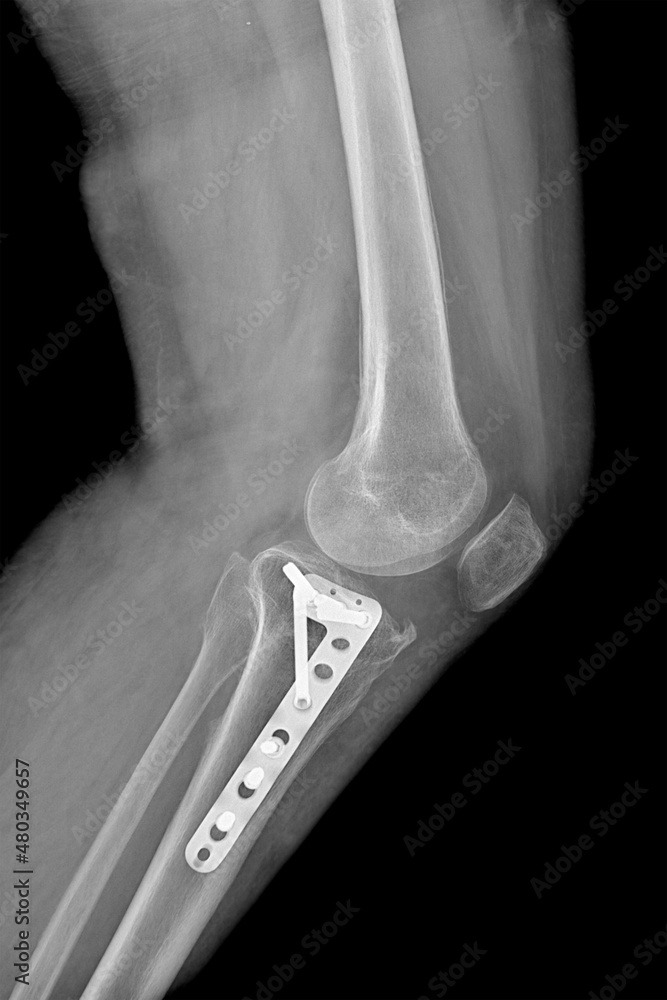 Radiography of the operated Tibia, in lateral-lateral projection, in a ...