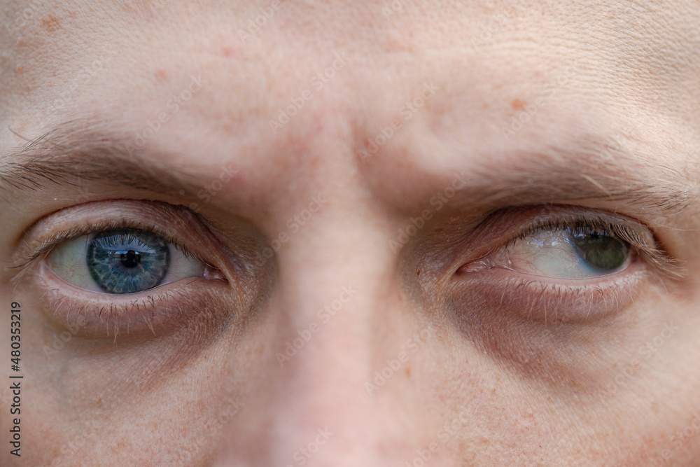 full face macro photo of a man with strabismus and blindness of one eye ...