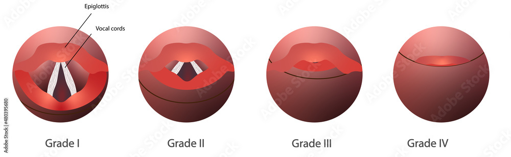 Cormack-Lehane system to assess the airway dificulty in intubation ...