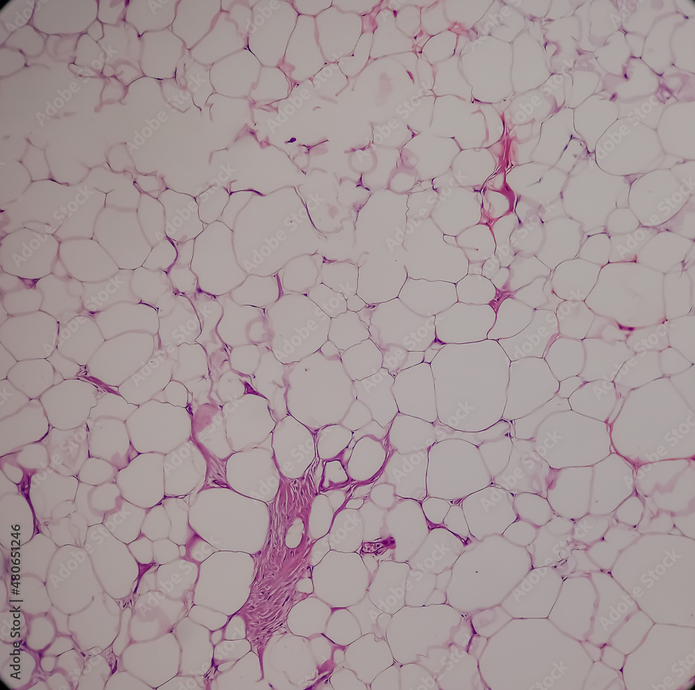 Lipoma, benign growth of fatty tissue, benign neoplasm, adipocytes ...