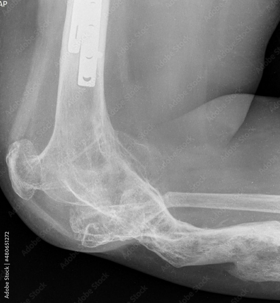 x ray image of knee osteomyelitis Stock Photo | Adobe Stock