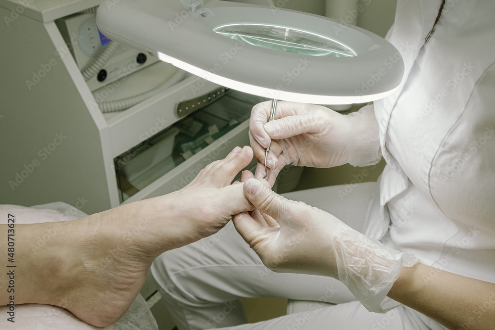 sore toenails of the patient the doctor examines under the lamp Stock ...