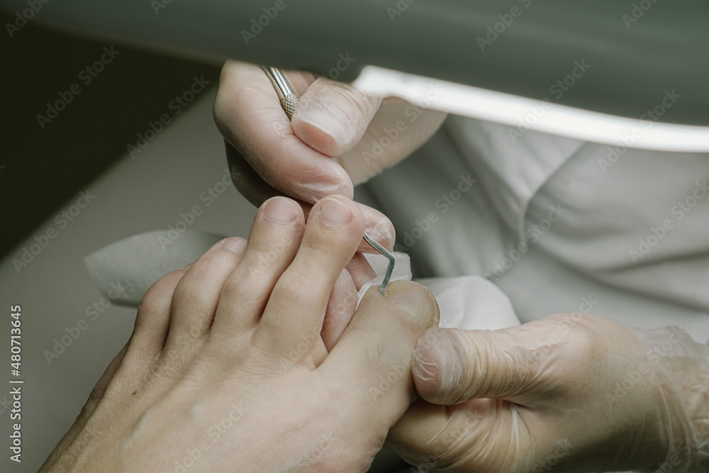 sore toenails of the patient the doctor examines under the lamp Stock ...