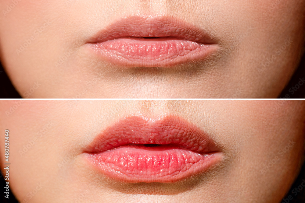 Result before and after lip shaping. A woman makes lip shape correction ...