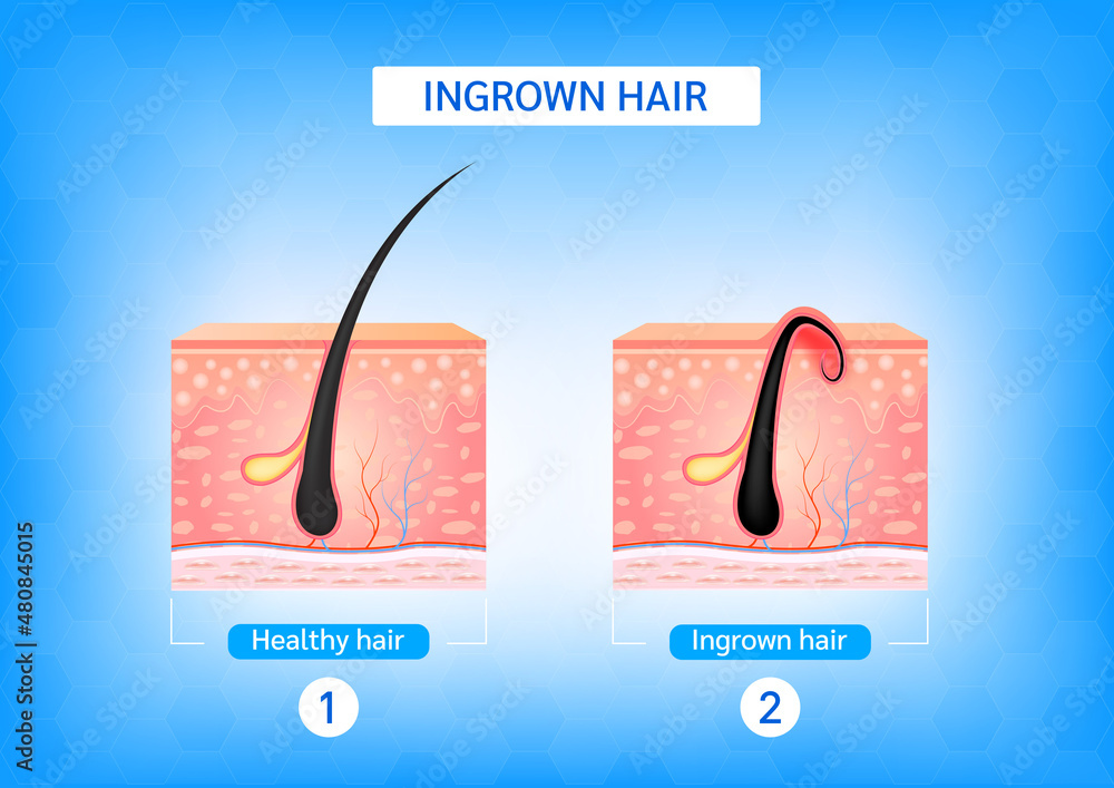 Ingrown hair. Hair has grown back into the skin surface after shaving ...