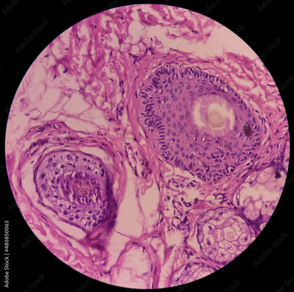 Tissue from face(biopsy): Microscopic image of intradermal nevus, show ...